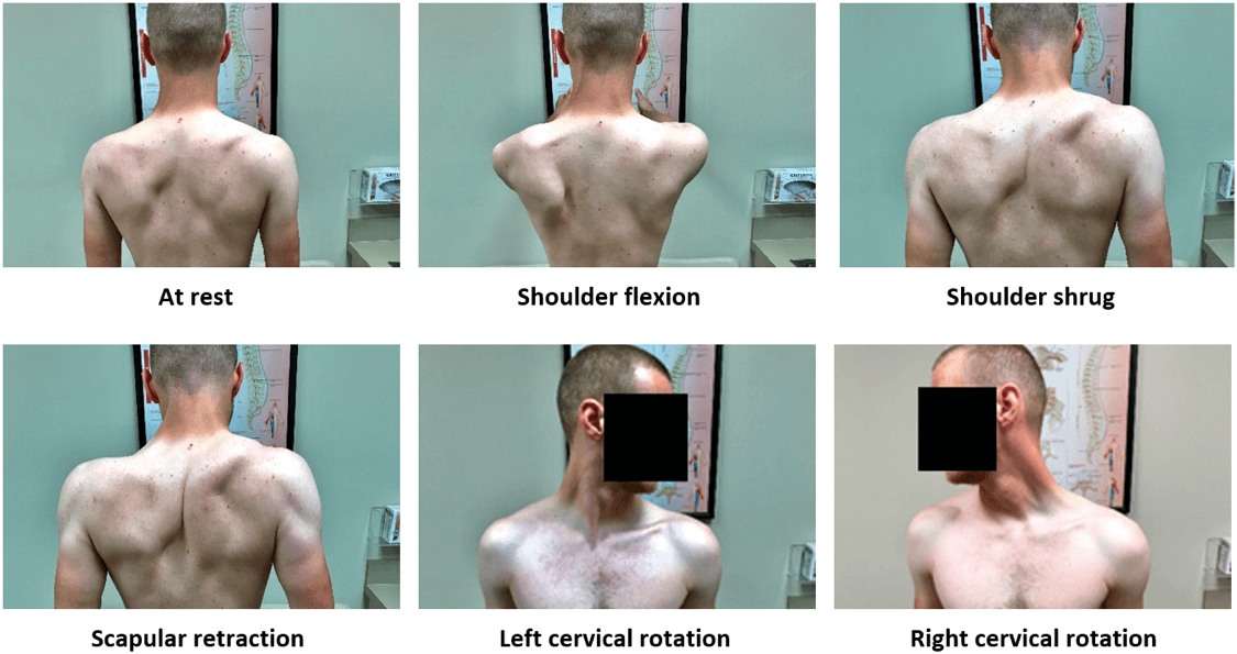 Shoulder Injuries in the United States Army - EMG Solutions