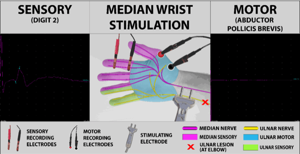 The “Ulnar Hand:” Three Case Studies - EMG Solutions