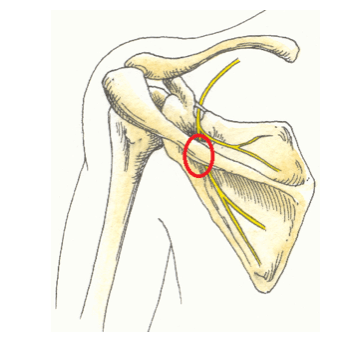 Suprascapular Nerve Compromise - EMG Solutions