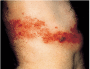 Shingles and Your Nerves - EMG Solutions